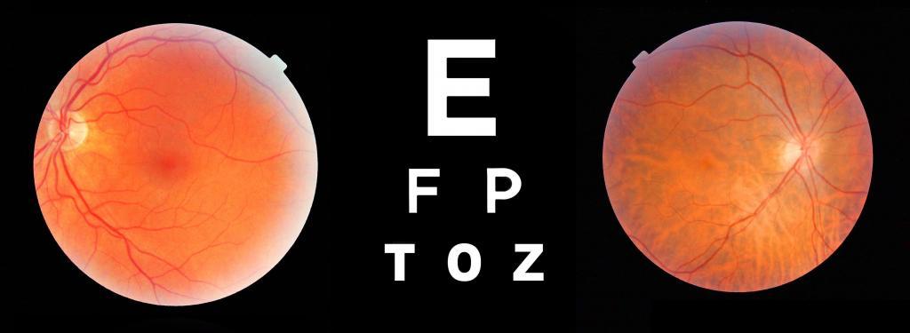 Understanding Optic Nerve Imaging towards Glaucoma |Open Medscience