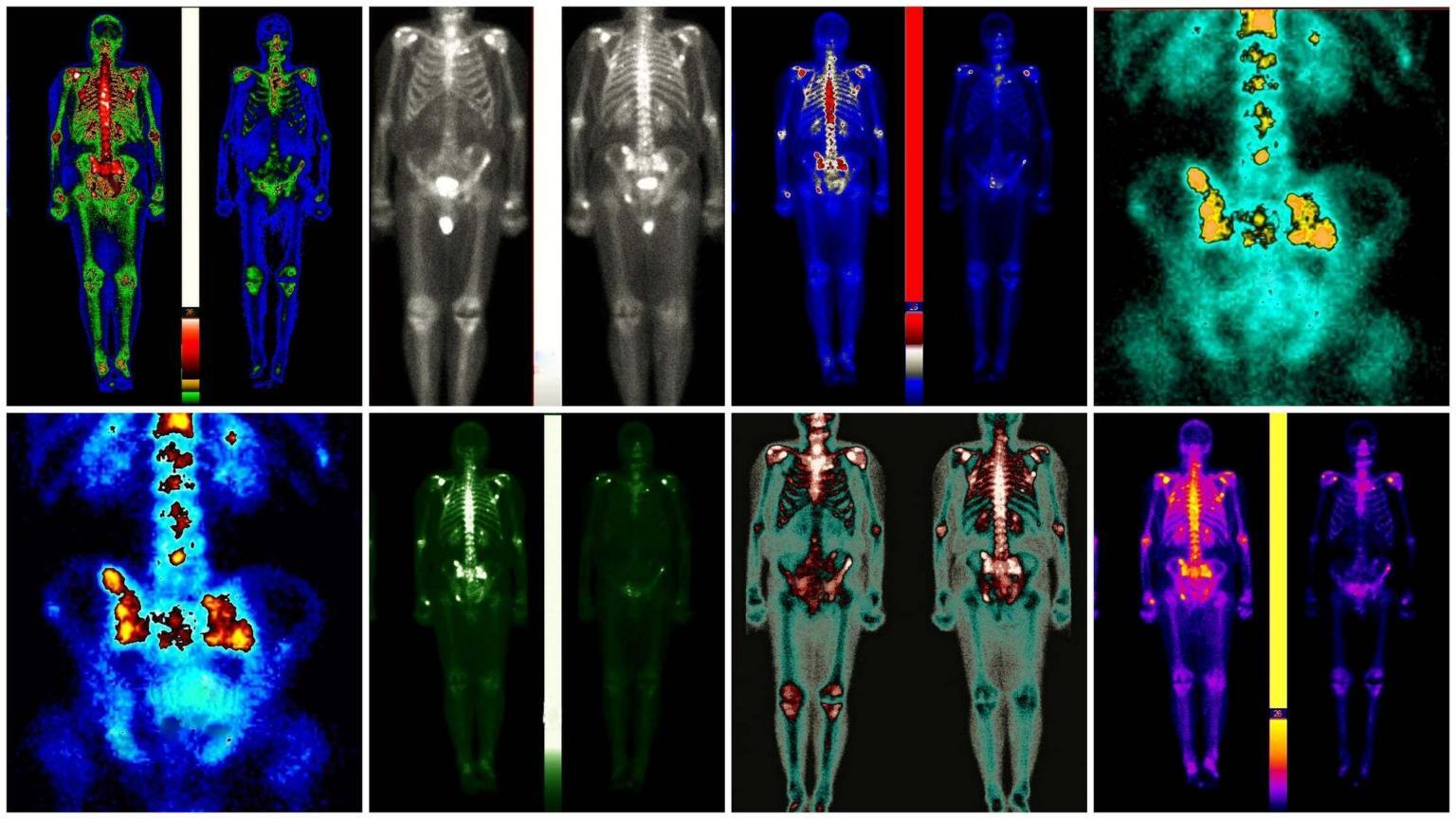 Targeted radionuclide therapy (TAT) | Open Medscience