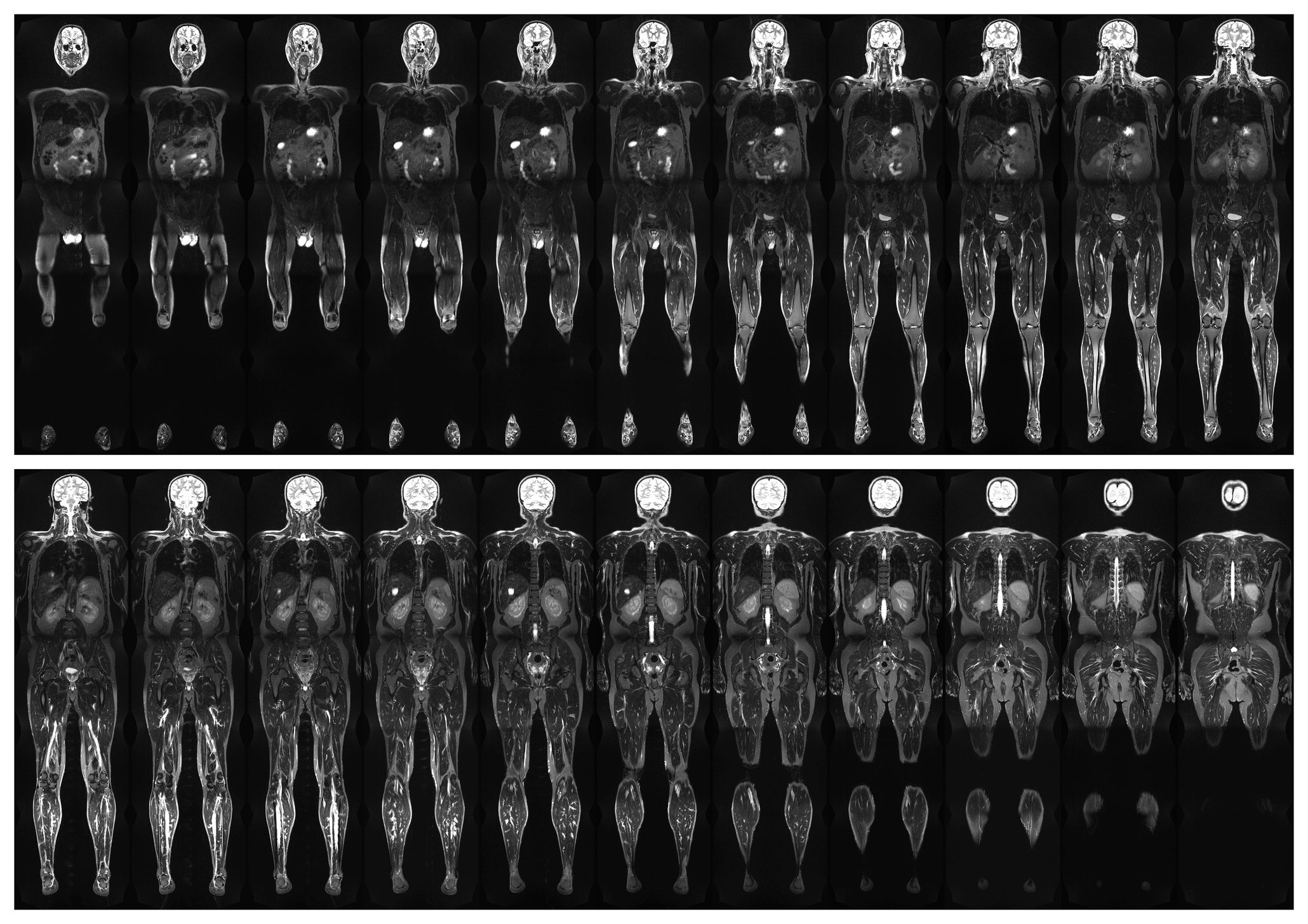 Quantitative Whole-Body MRI Evaluation | Open Medscience