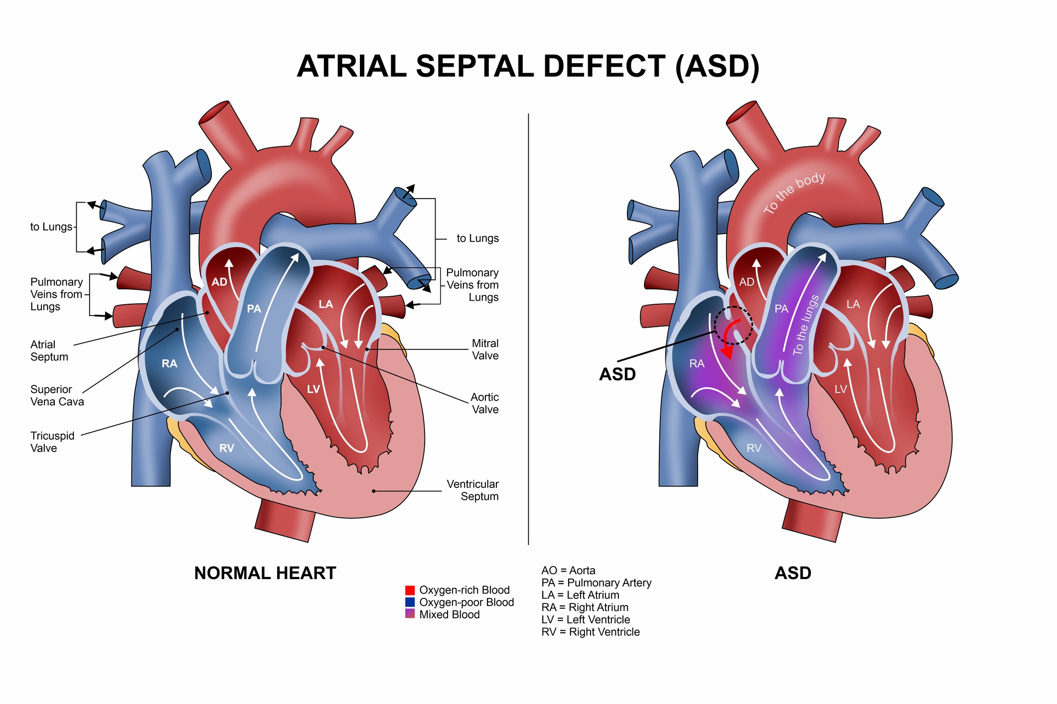 Atrial Septal Defect Symptoms in Adults | Open Medscience