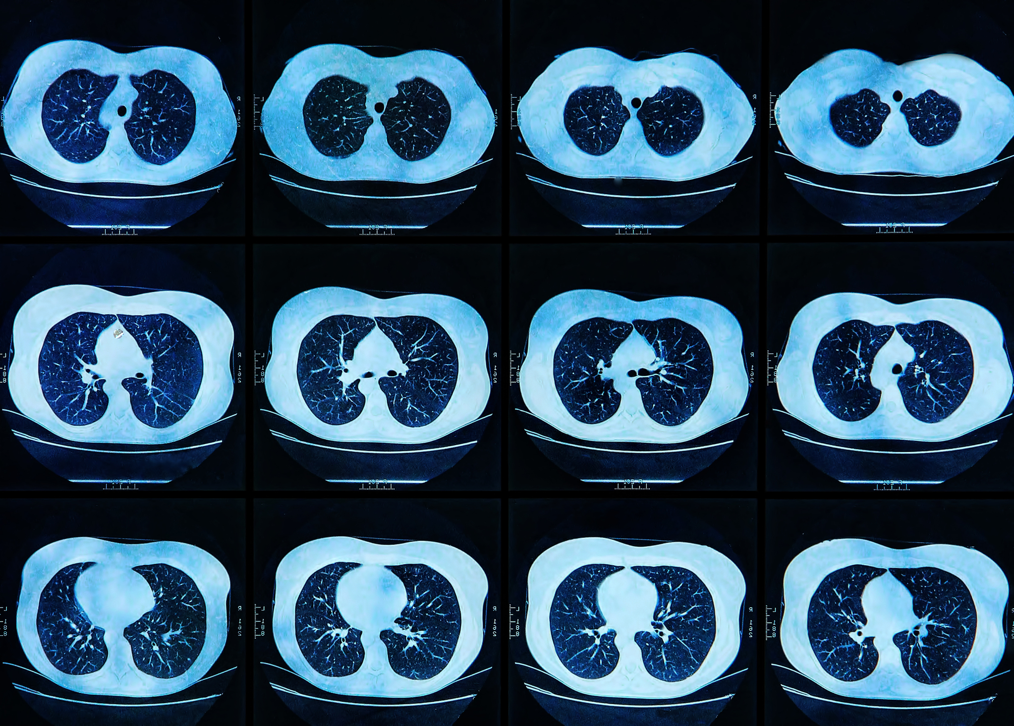 AI-Powered Low-Field MRI in Lung Imaging | Open Medscience