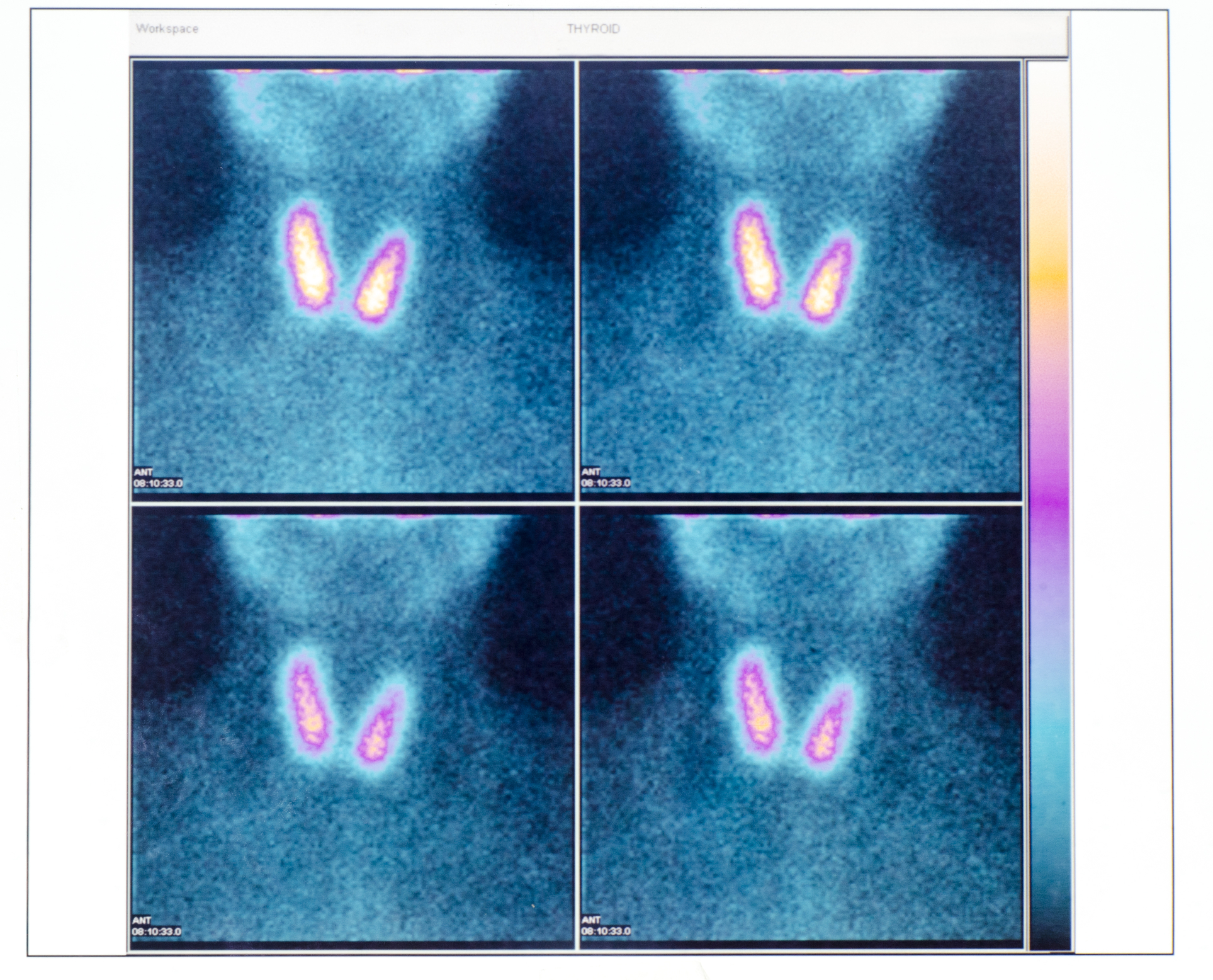 Thyroid Cancer Diagnosis using PET/CT | Open Medscience